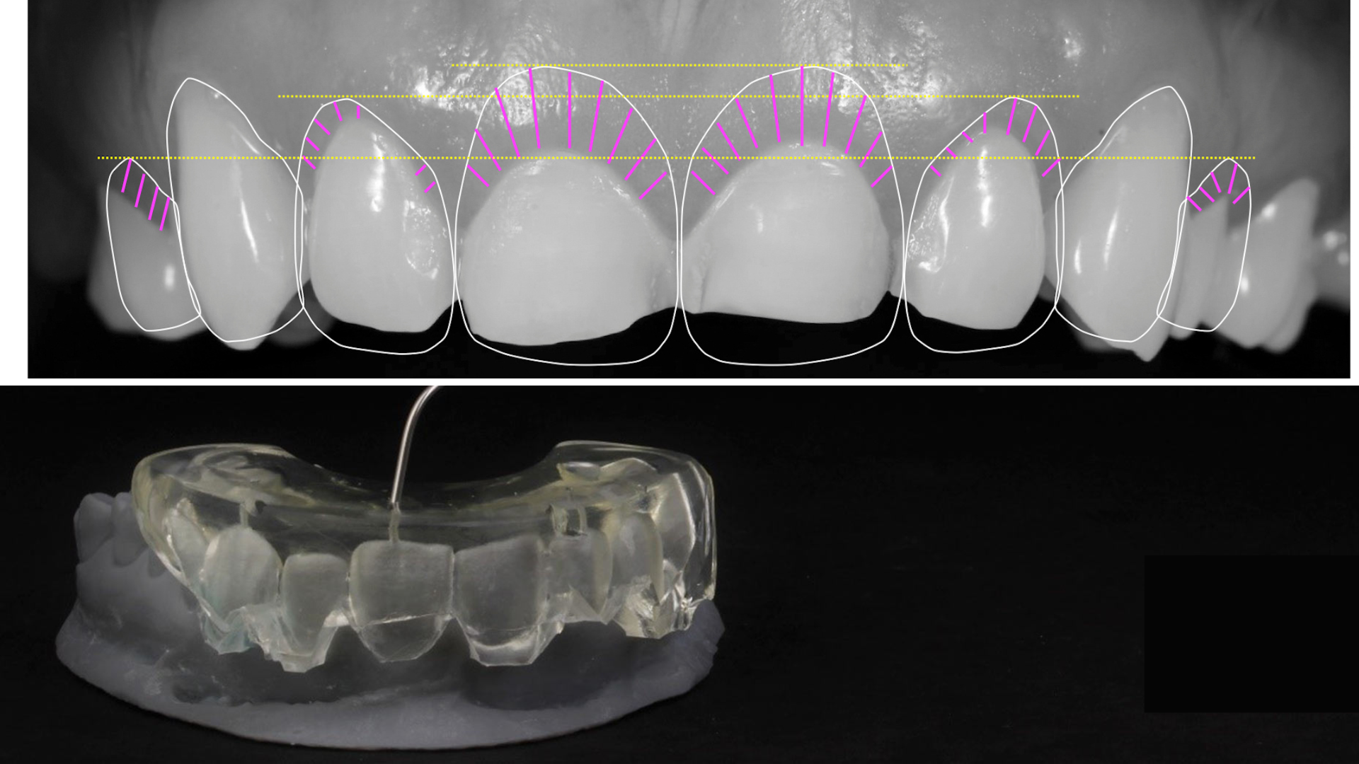 DISEÑO DE SONRISA Y LLAVE PARA CARILLAS INYECTADAS POR ARCADA
